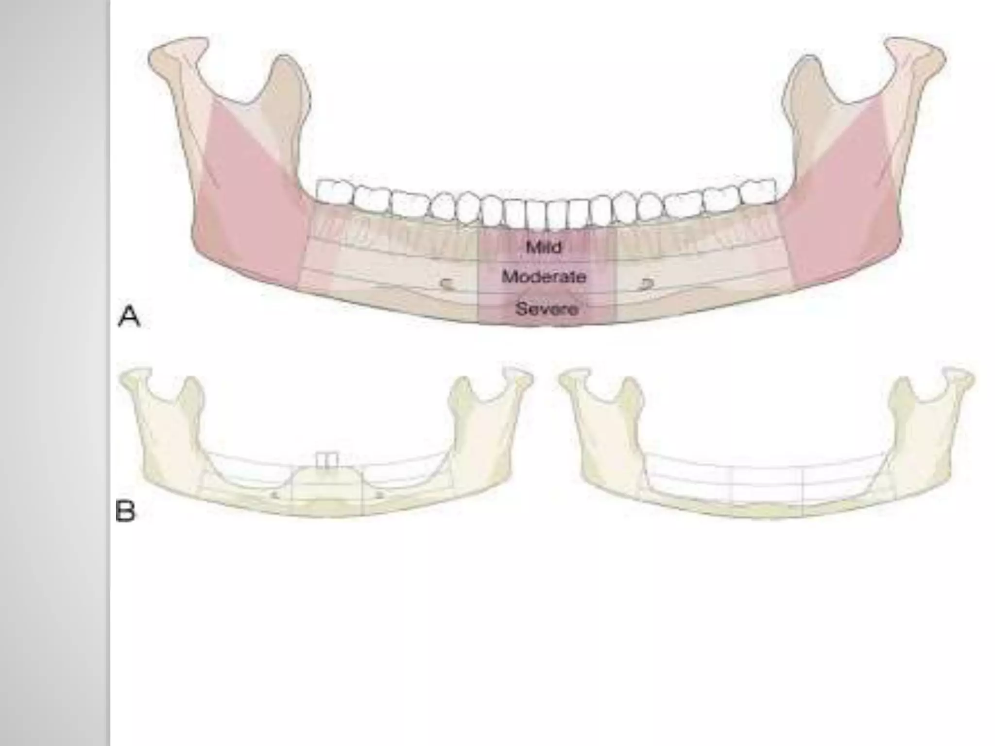 Classification of mandible fracture | PPTX