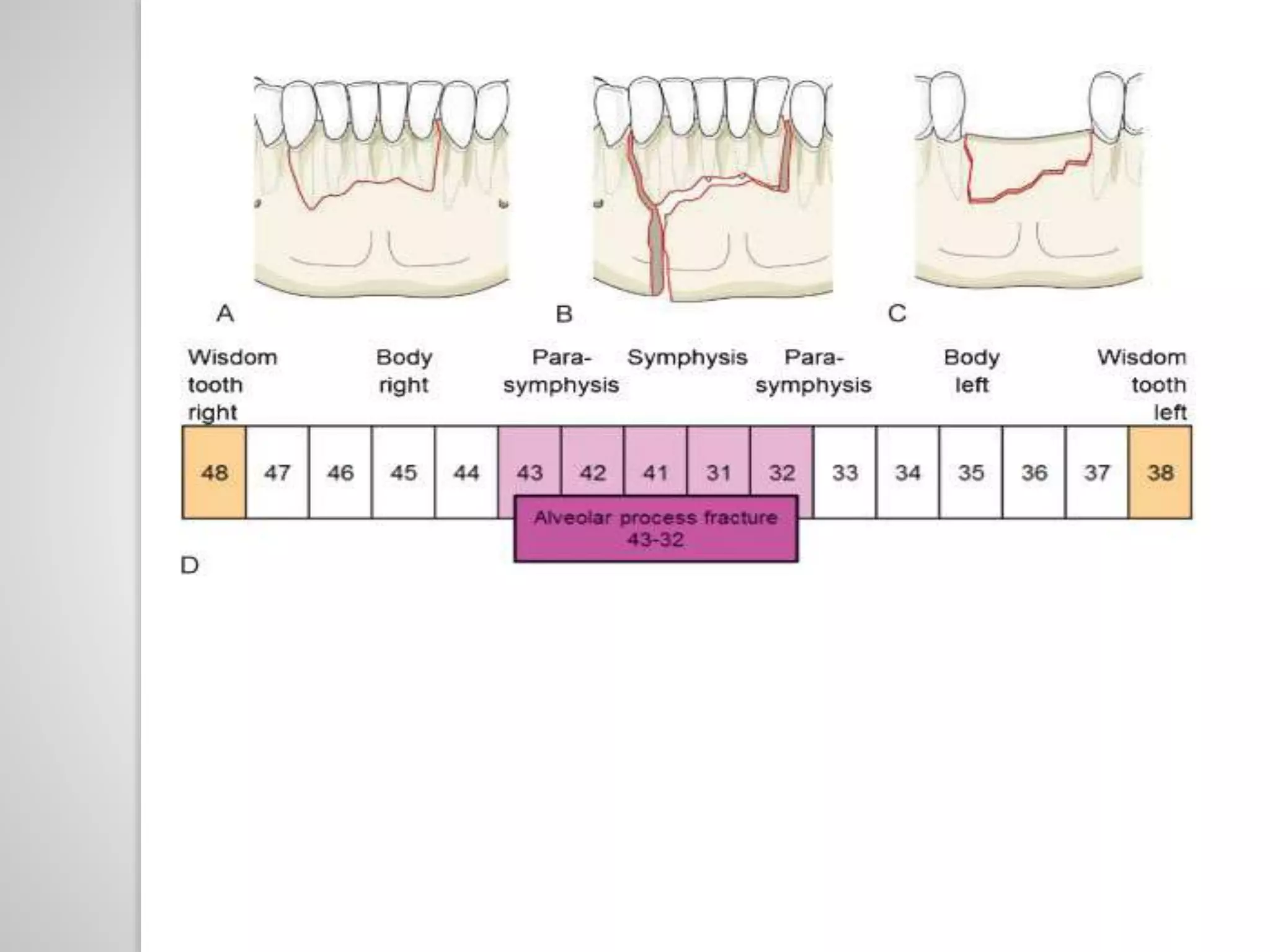 Classification of mandible fracture | PPTX