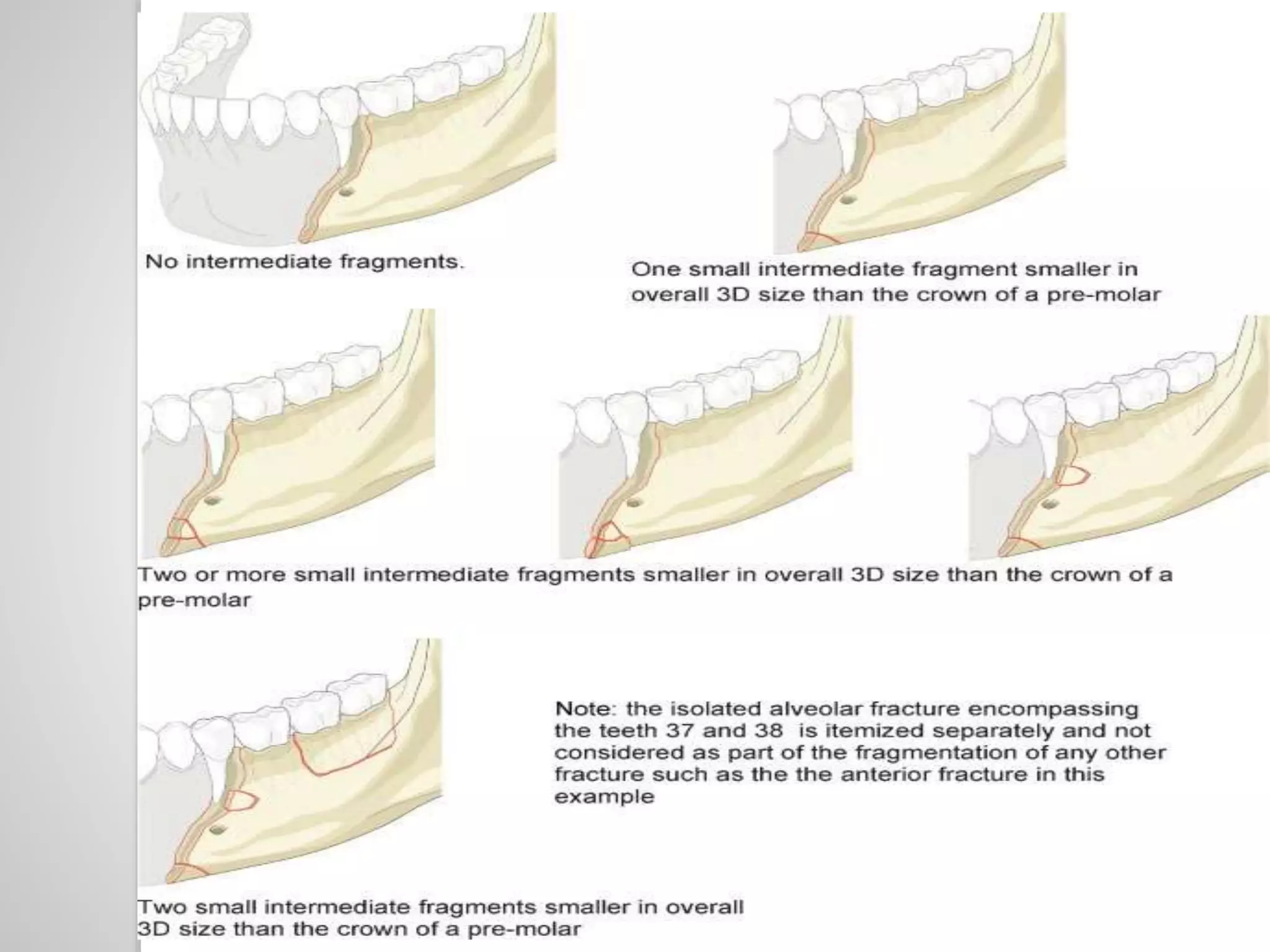 Classification of mandible fracture | PPTX