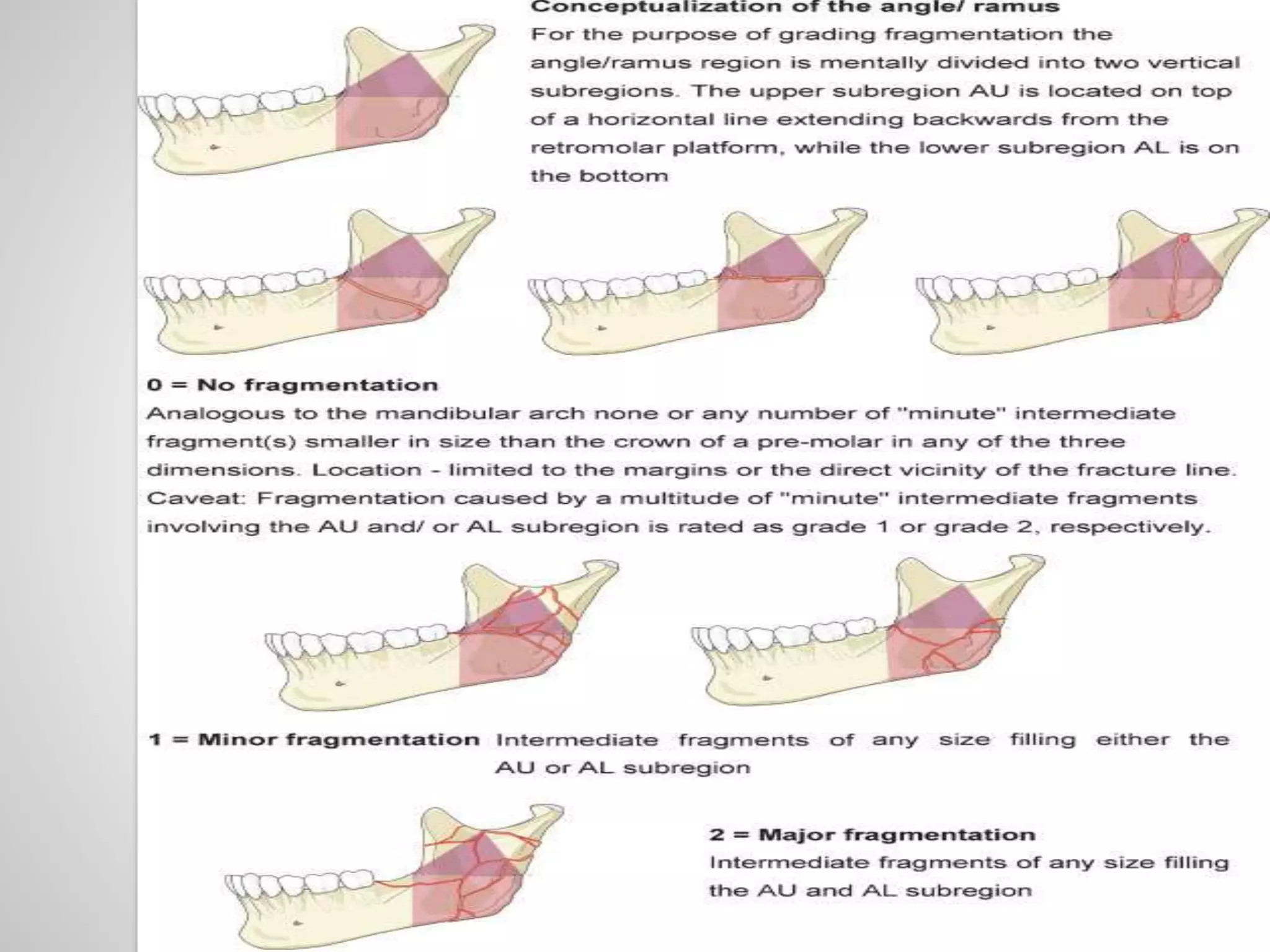 Classification of mandible fracture | PPTX