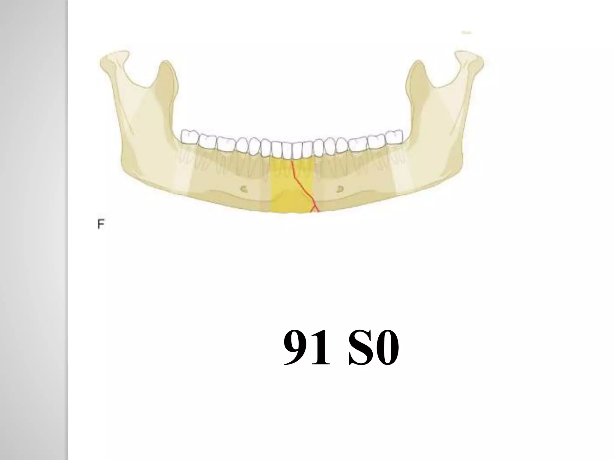 Classification of mandible fracture | PPTX