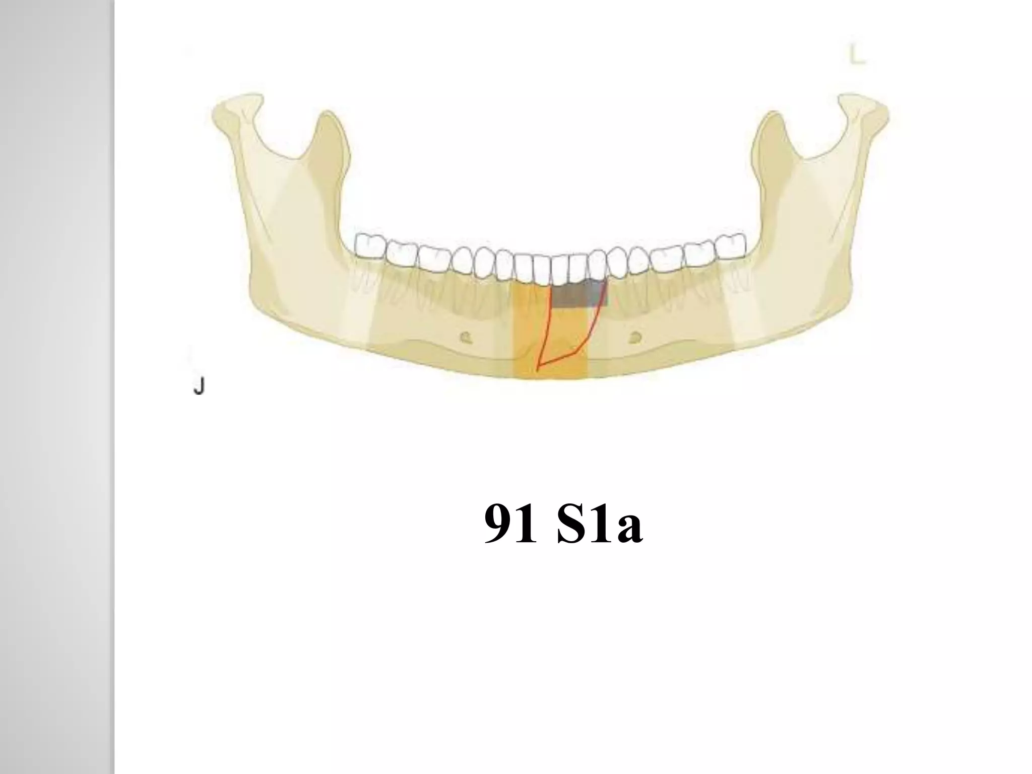 Classification of mandible fracture | PPTX