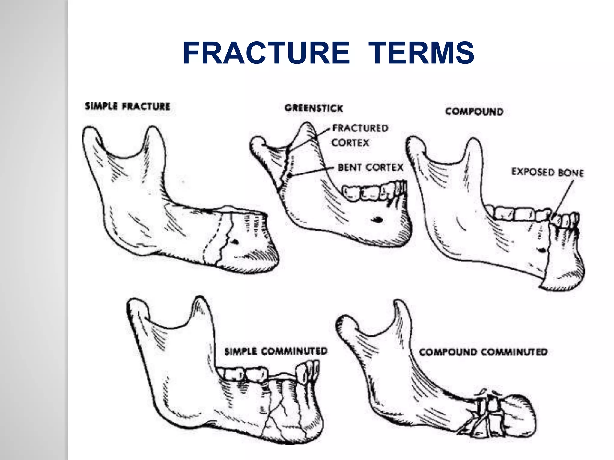 Types Of Mandibular Fracture Radiology