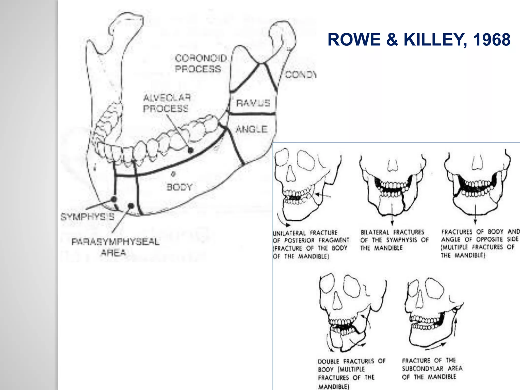 Mandible Fracture Mandibular Fractures Common Figure Emj Bmj Sketch ...