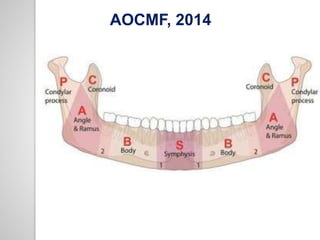 Classification of mandible fracture | PPTX