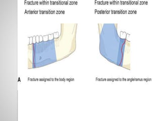 Classification of mandible fracture | PPTX