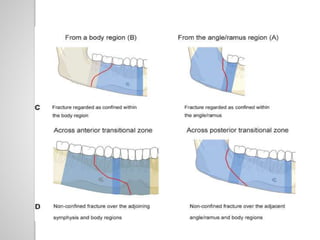 Classification of mandible fracture | PPTX