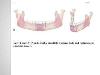 Classification of mandible fracture | PPTX