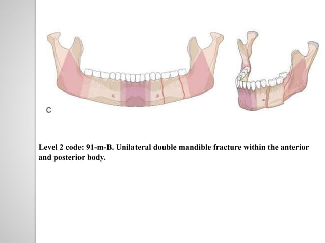Classification of mandible fracture | PPT