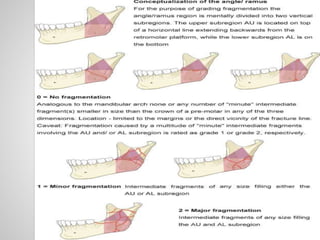 Classification of mandible fracture | PPTX