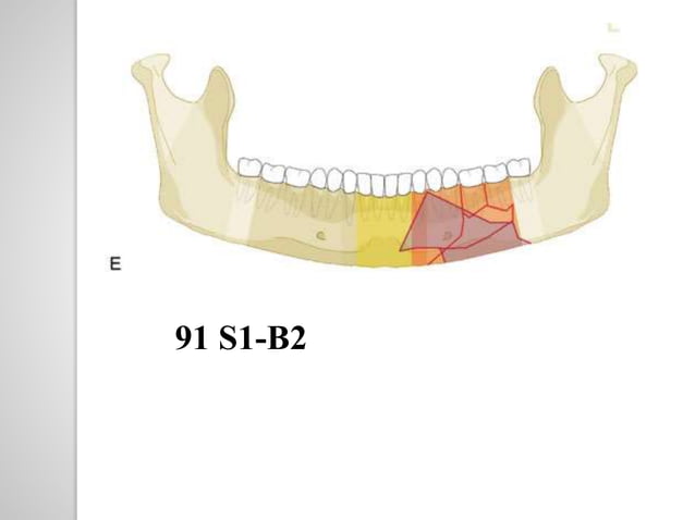 Classification of mandible fracture | PPTX | Death, Injury, or Military ...