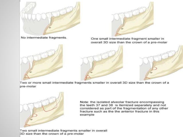 Classification of mandible fracture