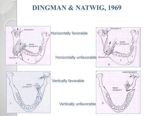 Classification of mandible fracture