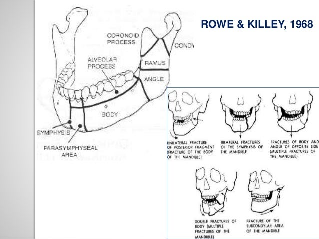 Classification of mandible fracture