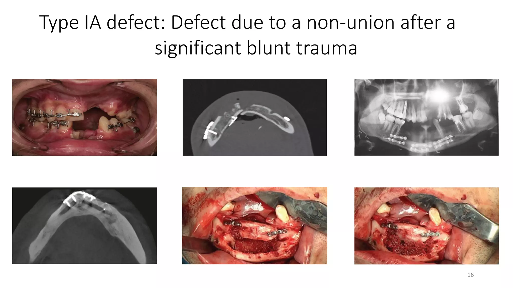 Classification of mandibular defects | PDF | Bone and Joint Conditions ...