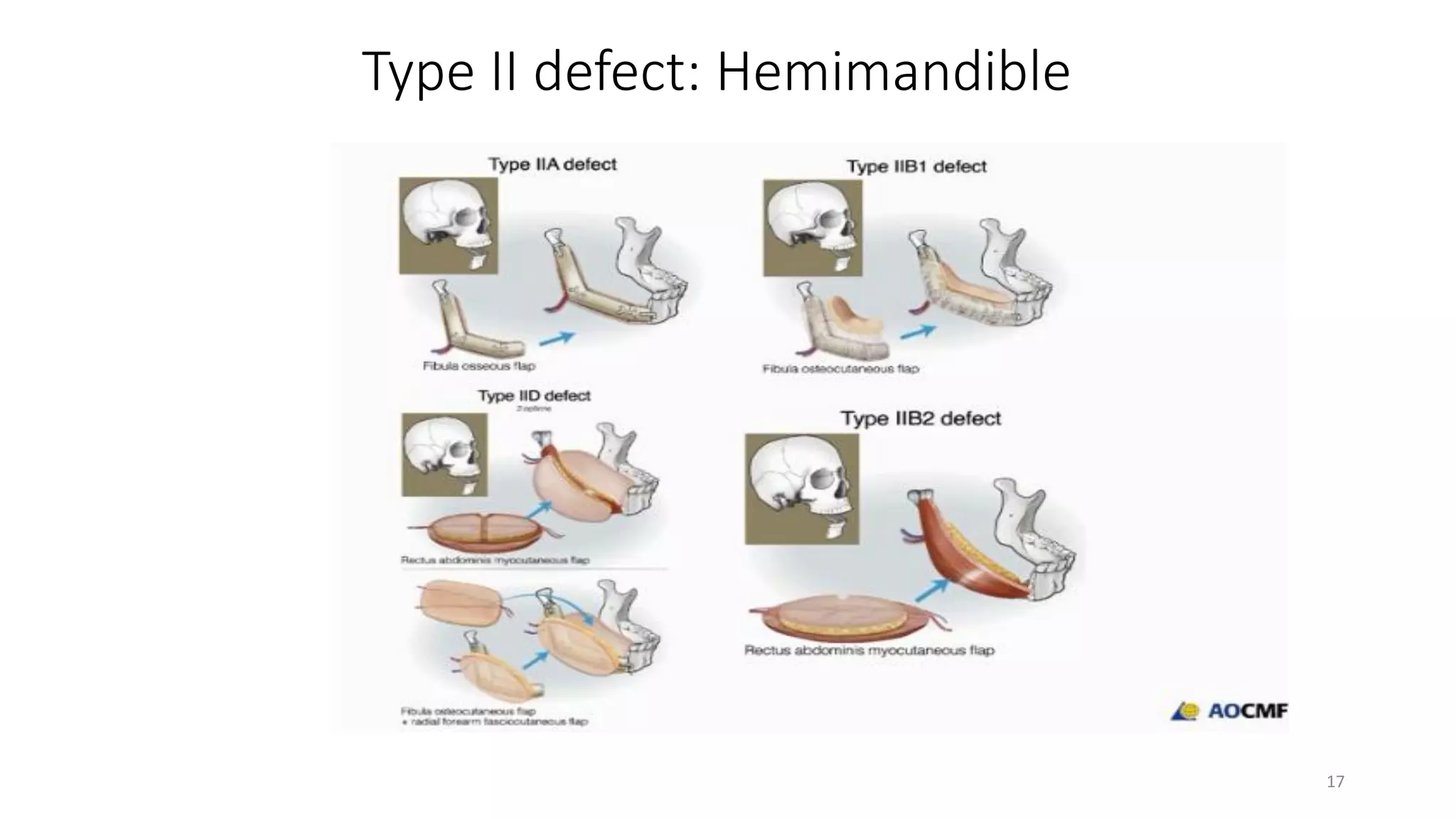 Classification of mandibular defects | PDF