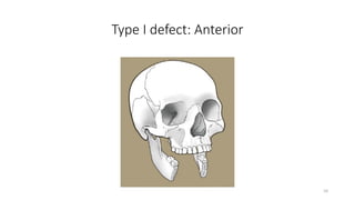 Classification of mandibular defects | PDF | Bone and Joint Conditions ...