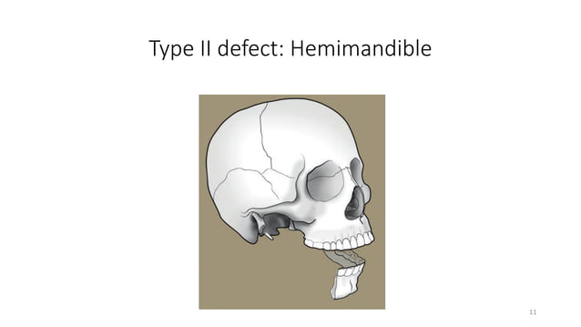 Classification of mandibular defects