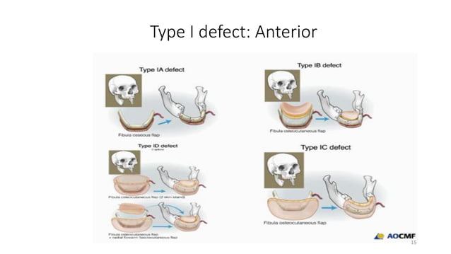 Classification of mandibular defects