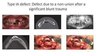 Classification of mandibular defects | PPT