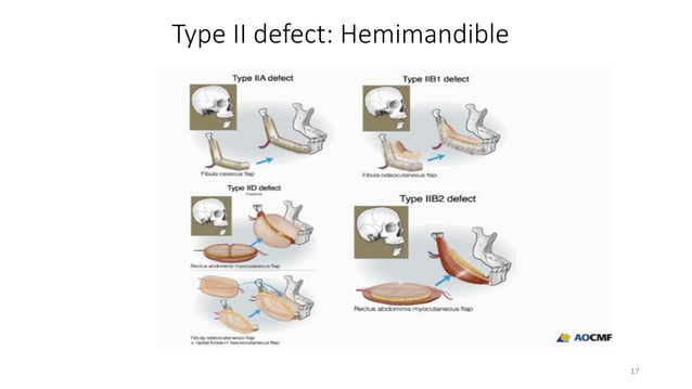 Classification of mandibular defects