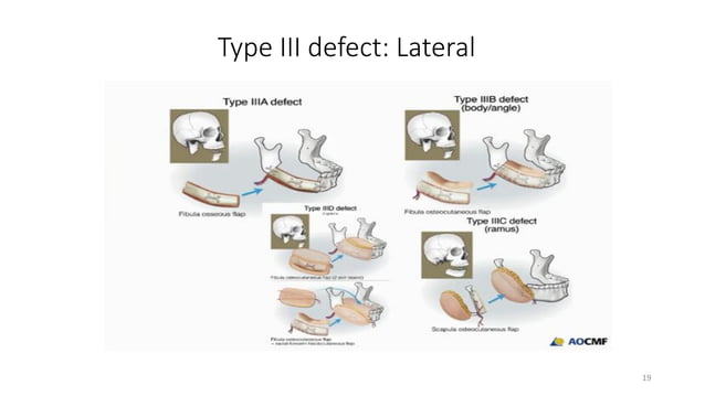 Classification of mandibular defects