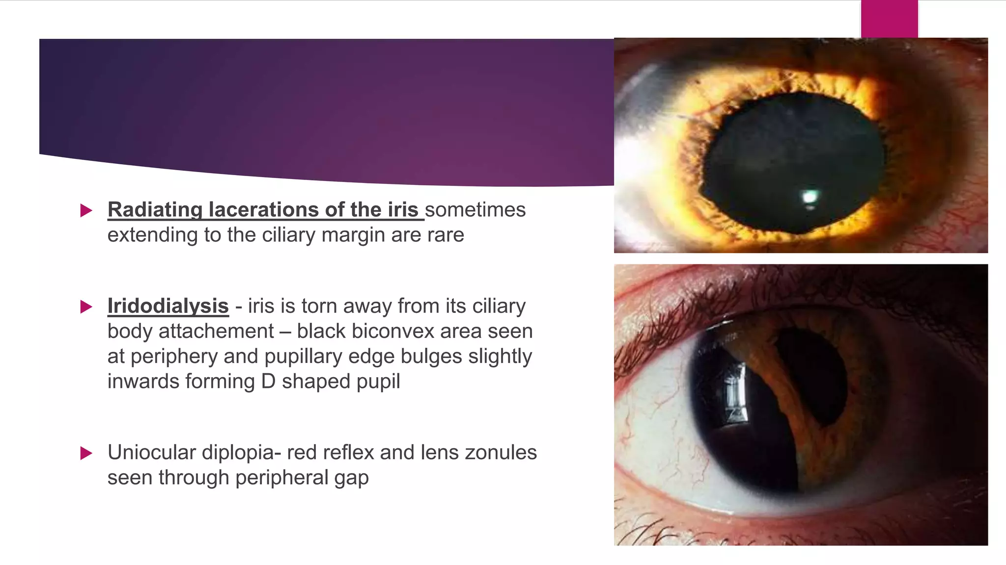 OCULAR TRAUMA - Classification of mechanical injuries, clinical ...