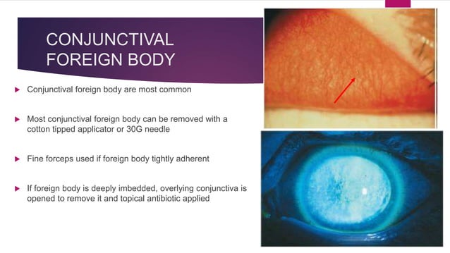 OCULAR TRAUMA - Classification of mechanical injuries, clinical ...