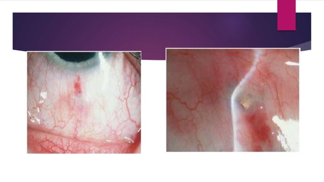 OCULAR TRAUMA - Classification of mechanical injuries, clinical ...