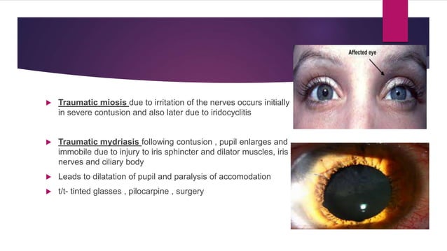 OCULAR TRAUMA - Classification of mechanical injuries, clinical ...