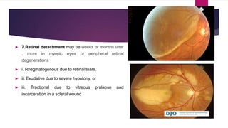 OCULAR TRAUMA - Classification of mechanical injuries, clinical ...