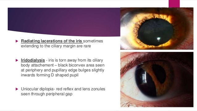 OCULAR TRAUMA - Classification of mechanical injuries, clinical featu…