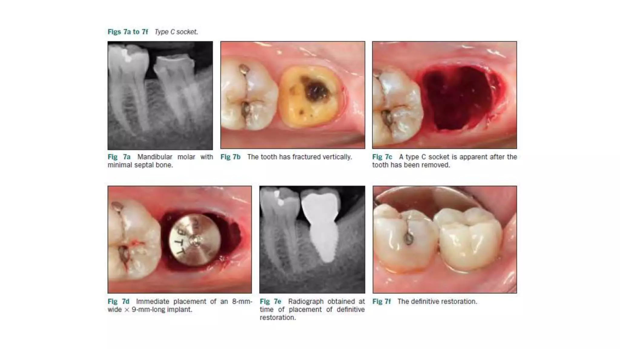 CLASSIFICATION Of molar extraction sites.pptx