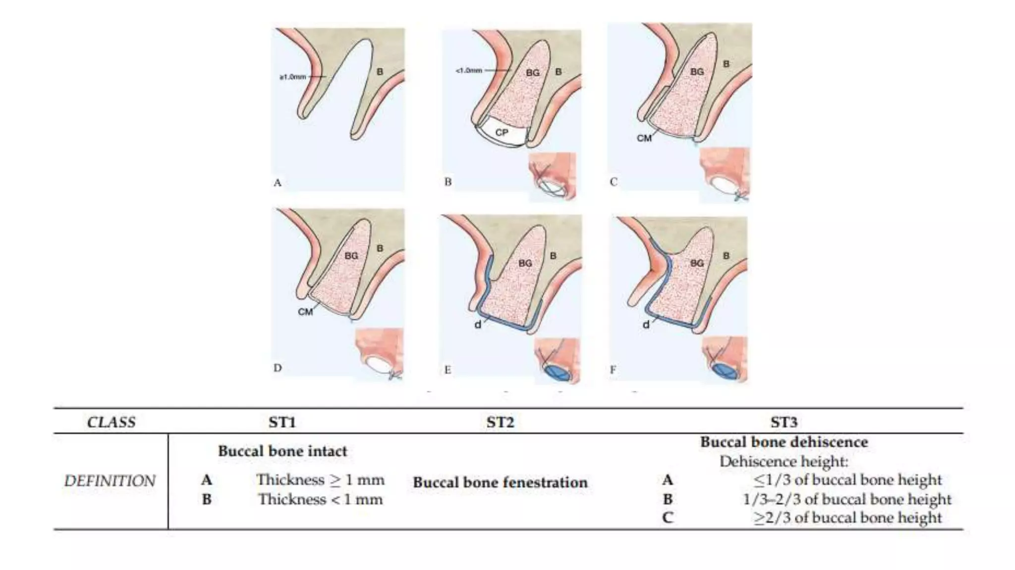 CLASSIFICATION Of molar extraction sites.pptx