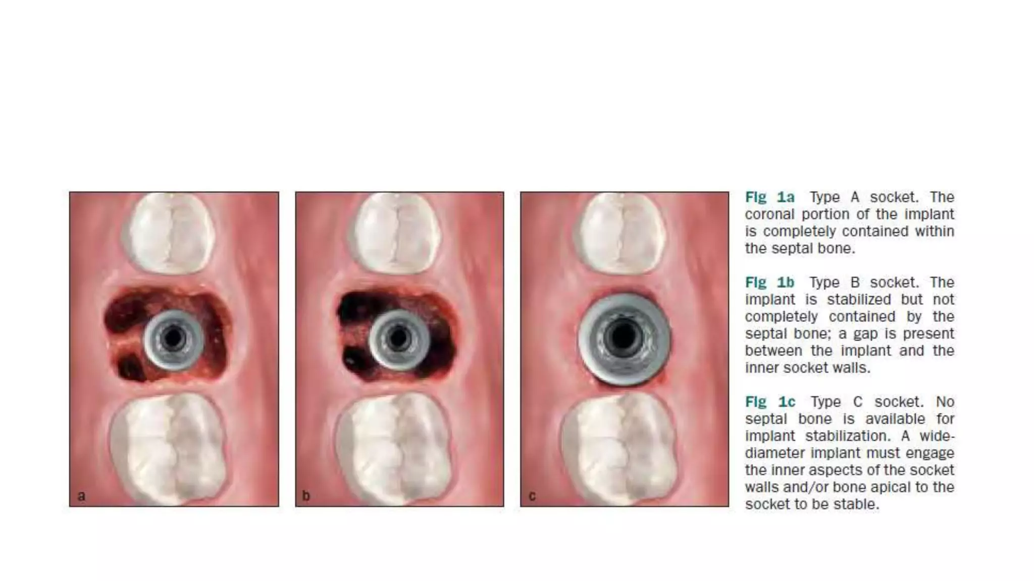 CLASSIFICATION Of molar extraction sites.pptx