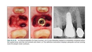 CLASSIFICATION Of molar extraction sites.pptx