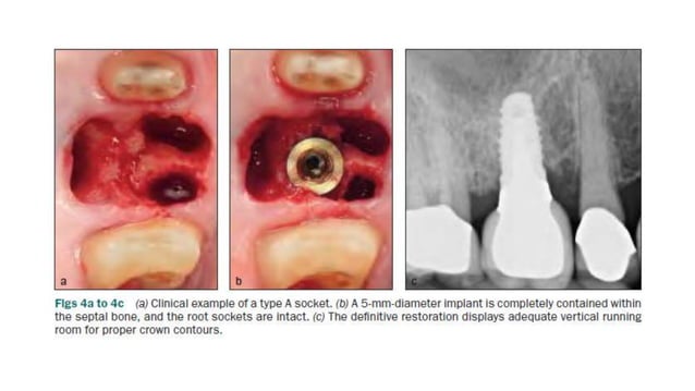 CLASSIFICATION Of molar extraction sites.pptx