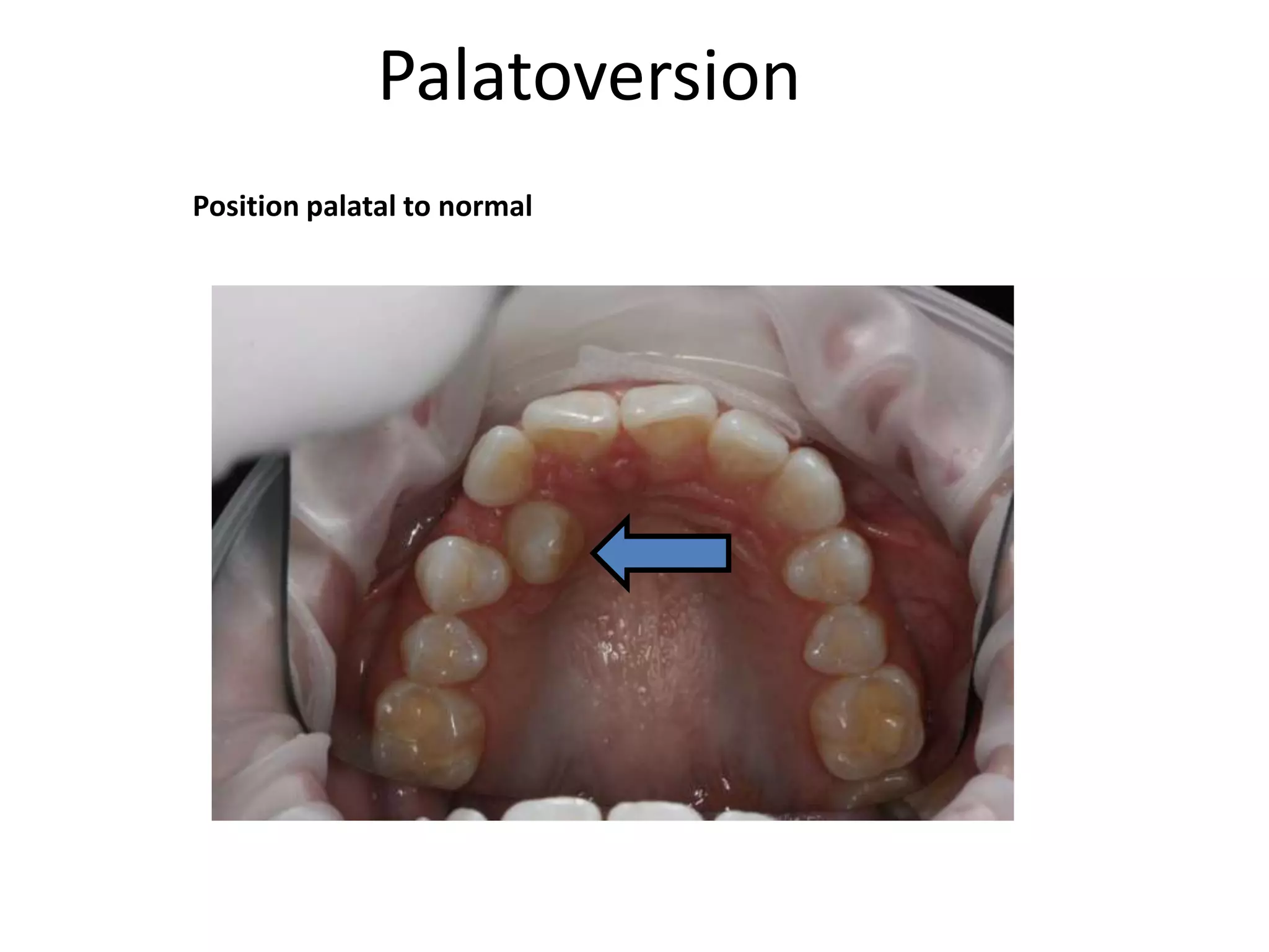 Classification of Occlusion and Malocclusion Dr. Nabil Al-Zubair | PDF