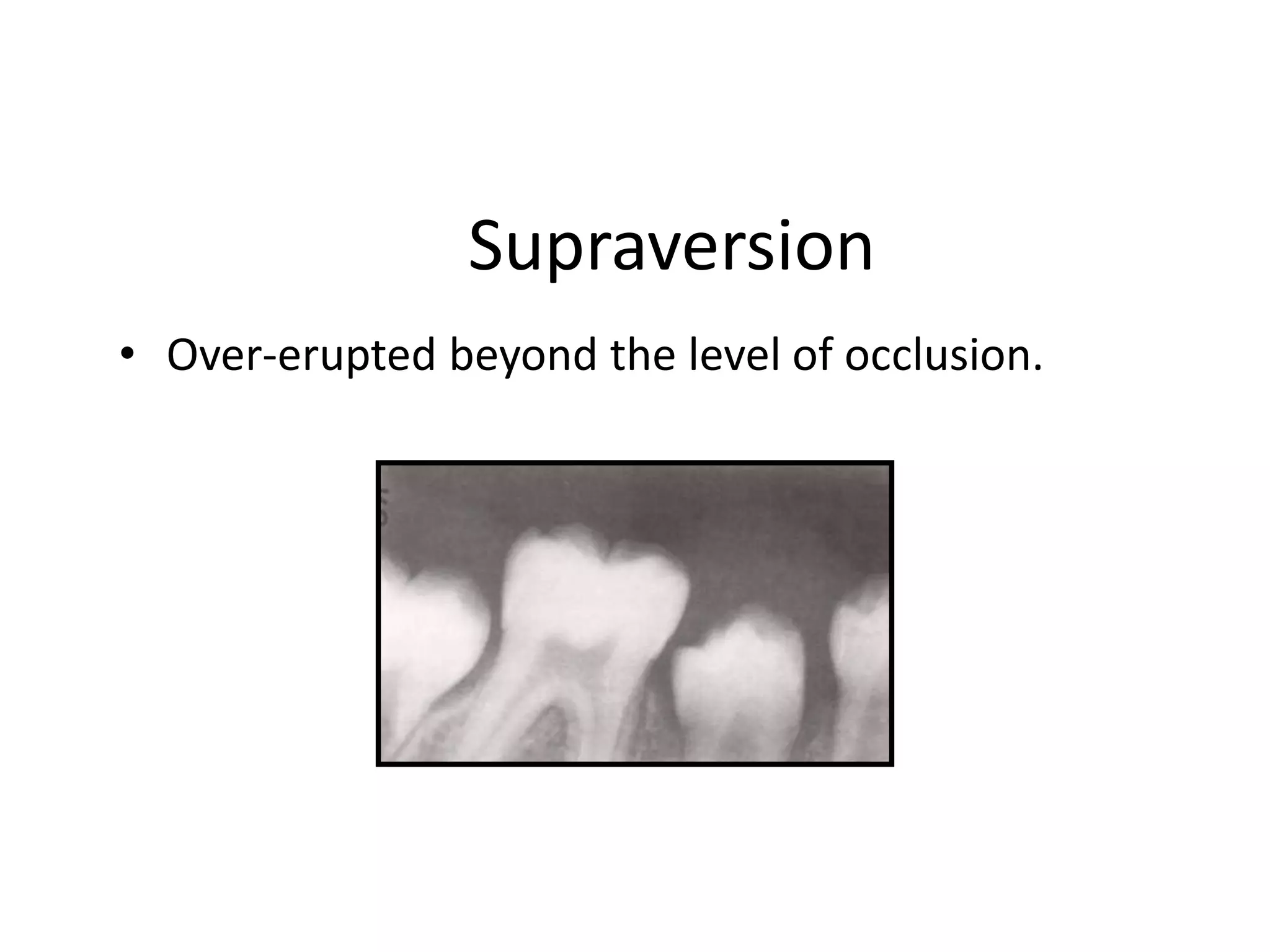 Classification of Occlusion and Malocclusion Dr. Nabil Al-Zubair | PDF
