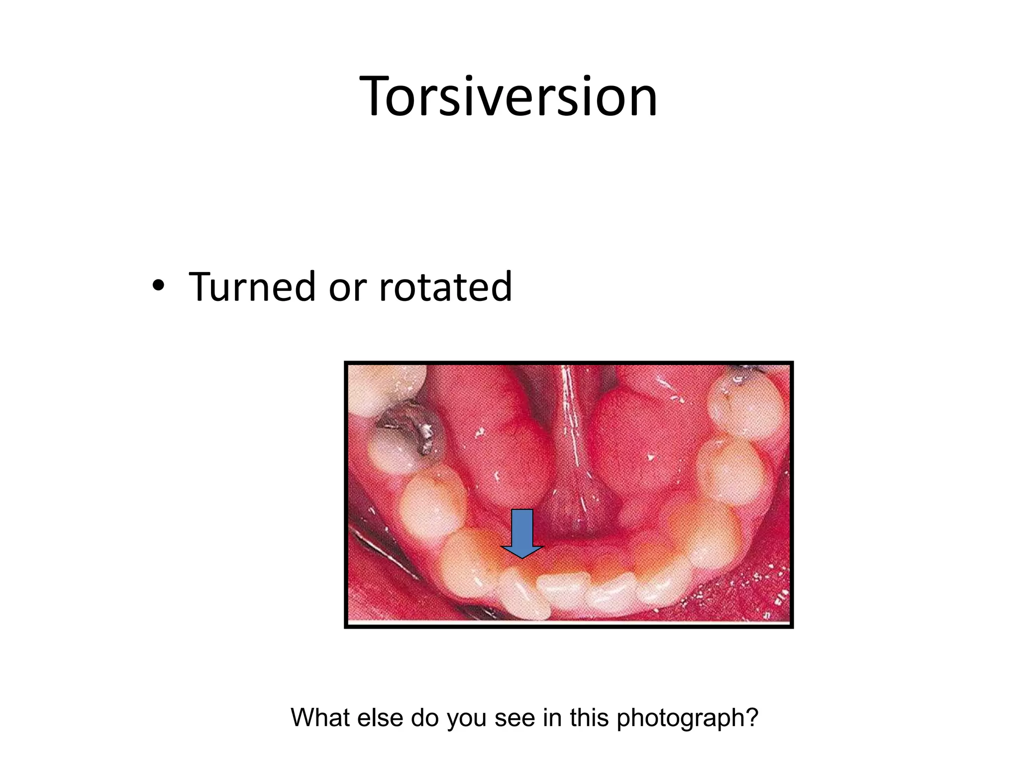 Classification of Occlusion and Malocclusion Dr. Nabil Al-Zubair | PDF