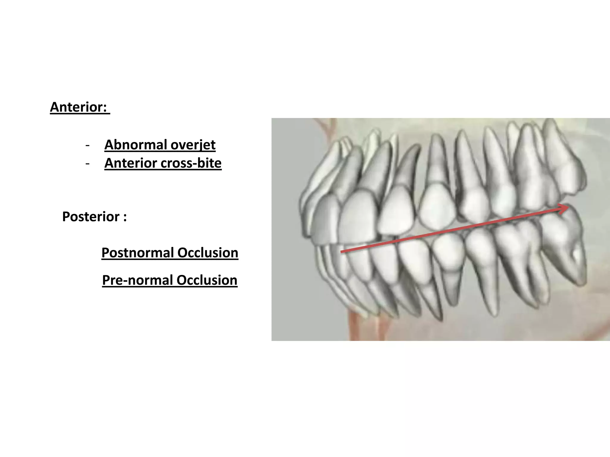 Classification of Occlusion and Malocclusion Dr. Nabil Al-Zubair | PDF