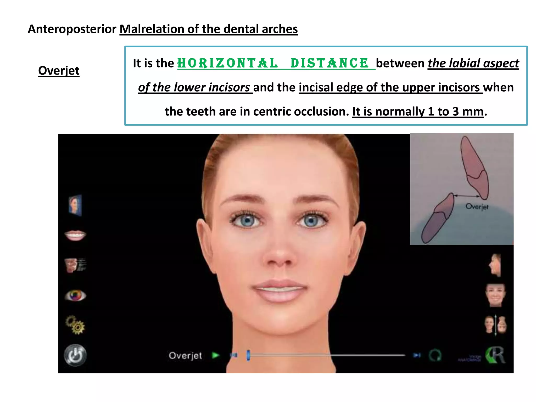 Classification of Occlusion and Malocclusion Dr. Nabil Al-Zubair | PDF