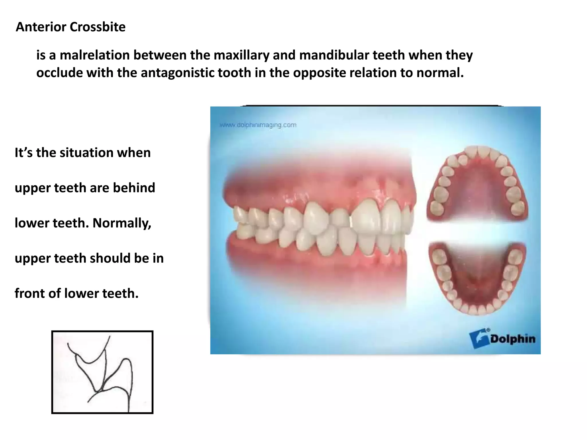 Classification of Occlusion and Malocclusion Dr. Nabil Al-Zubair | PDF