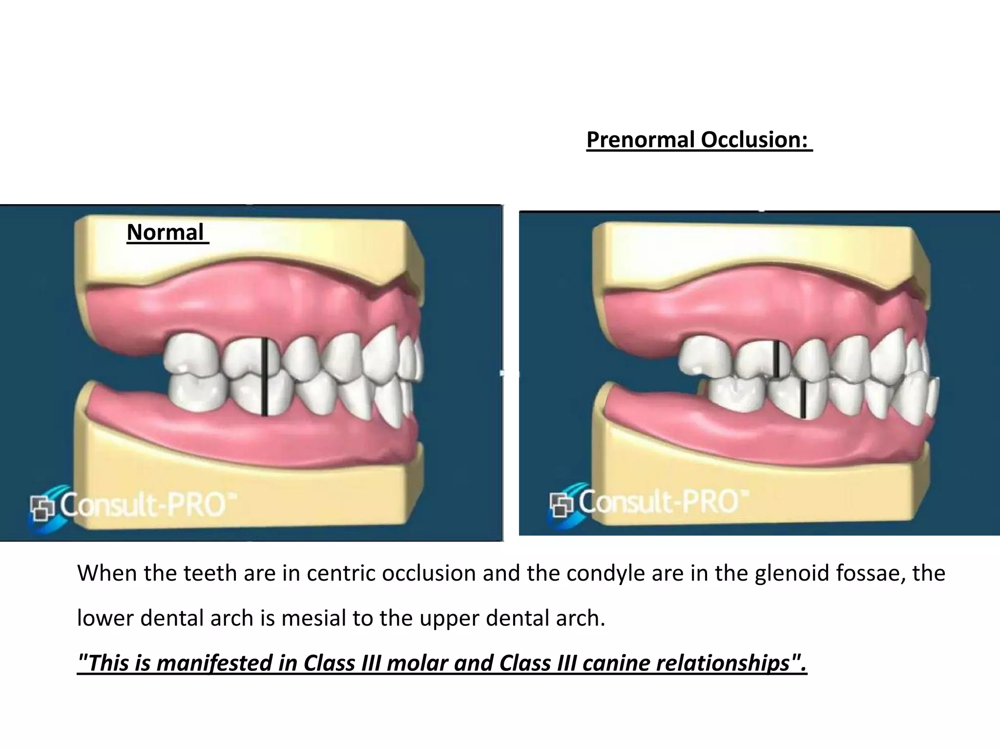 Classification of Occlusion and Malocclusion Dr. Nabil Al-Zubair | PDF
