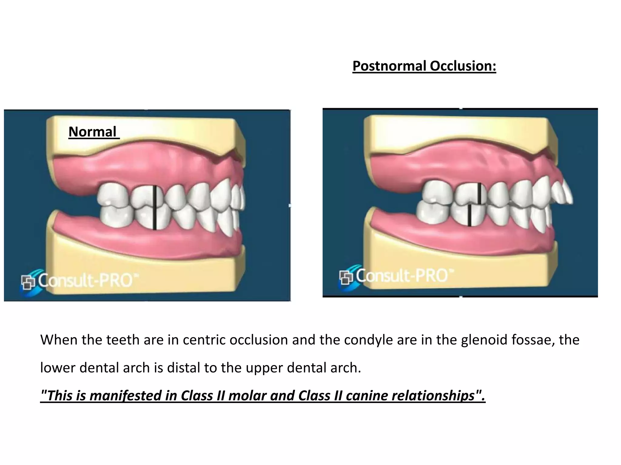 Classification of Occlusion and Malocclusion Dr. Nabil Al-Zubair | PDF