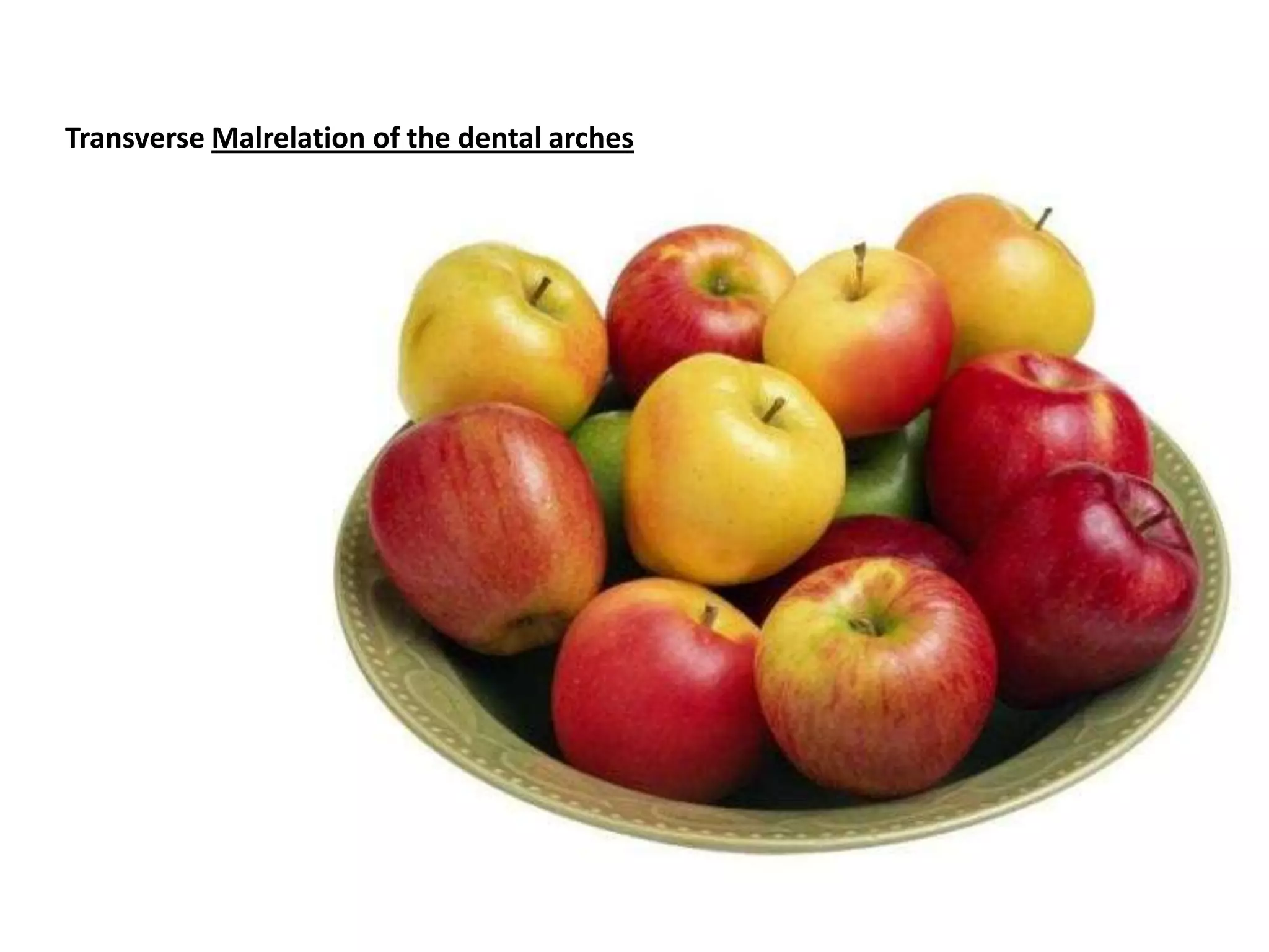 Classification of Occlusion and Malocclusion Dr. Nabil Al-Zubair | PDF