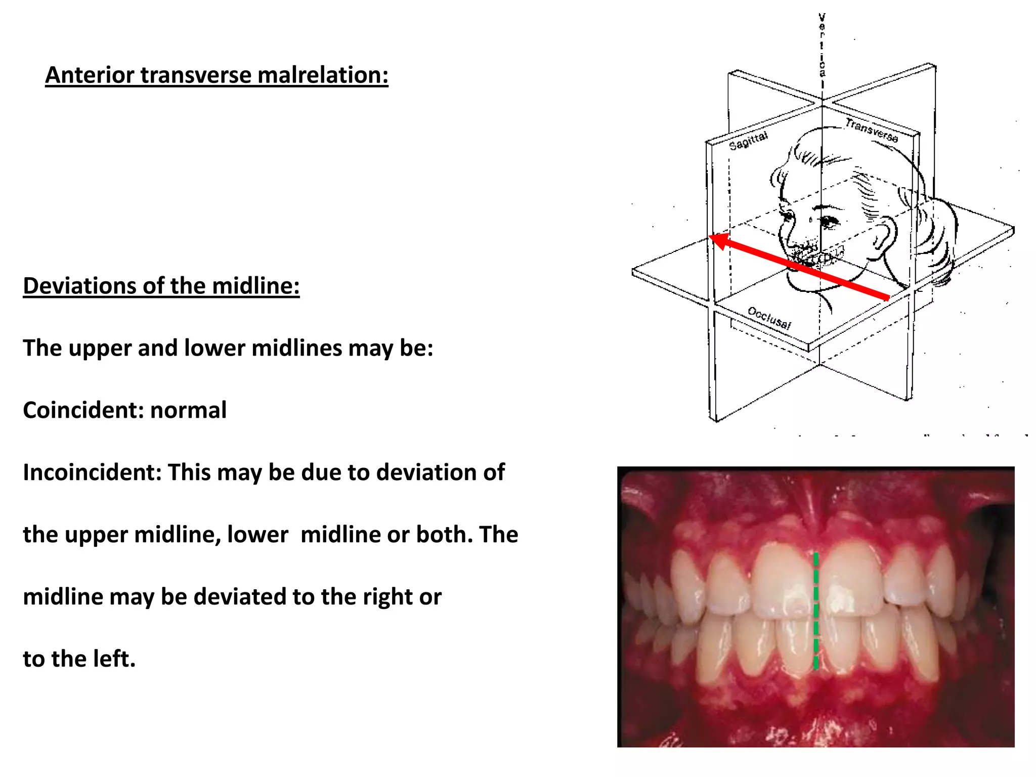 Classification of Occlusion and Malocclusion Dr. Nabil Al-Zubair | PDF
