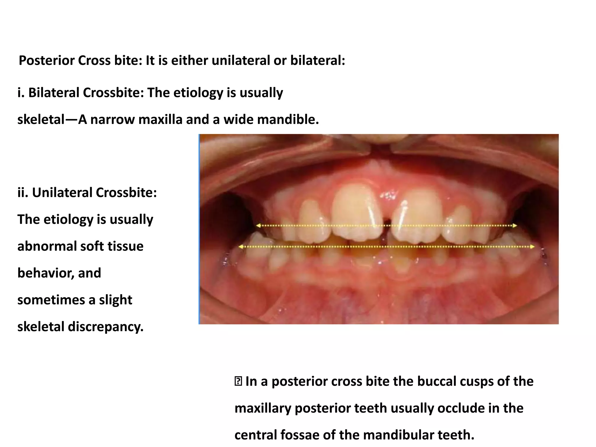 Classification of Occlusion and Malocclusion Dr. Nabil Al-Zubair | PDF