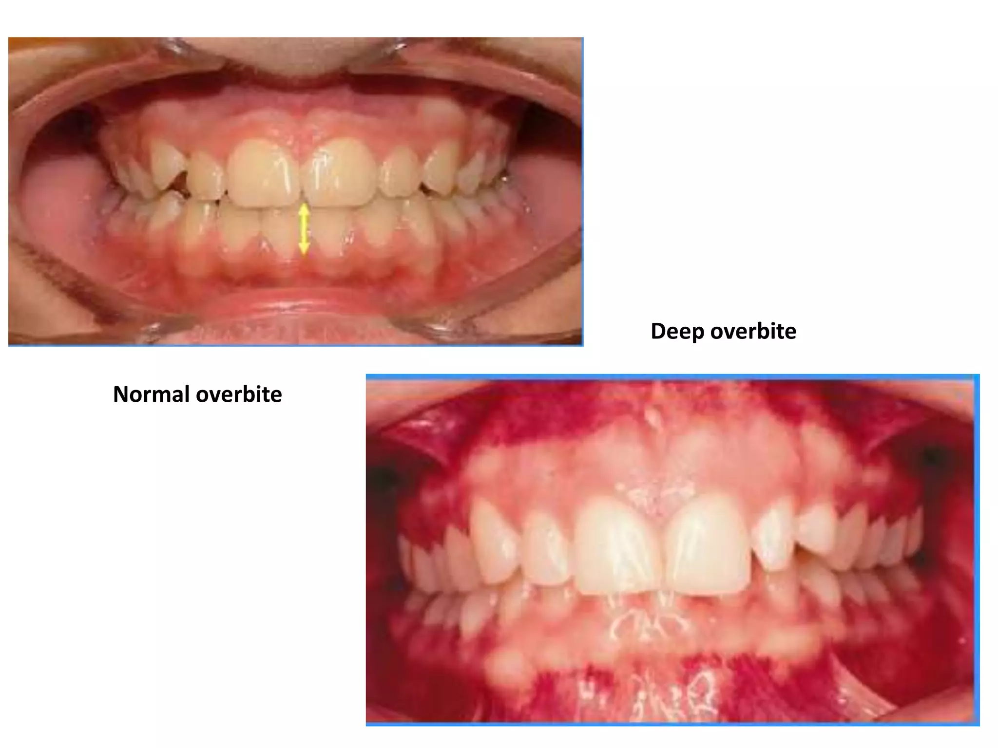 Classification of Occlusion and Malocclusion Dr. Nabil Al-Zubair | PDF