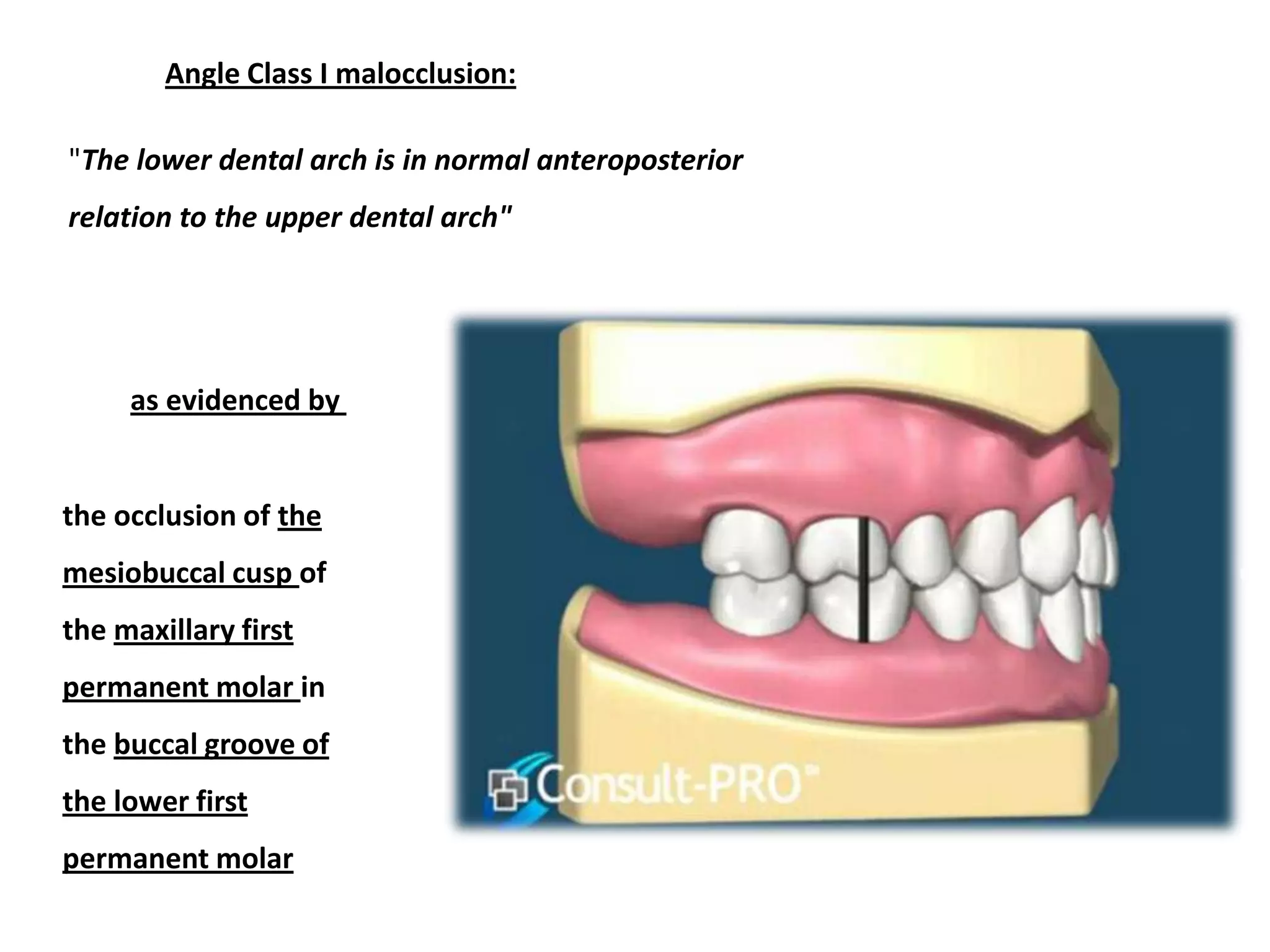 Classification of Occlusion and Malocclusion Dr. Nabil Al-Zubair | PDF